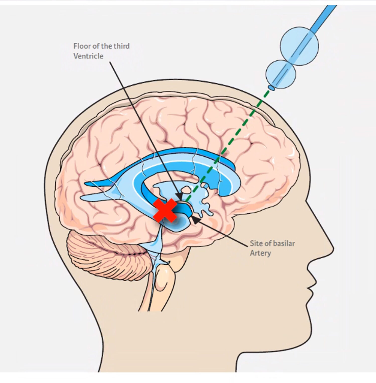 Treatment Endoscopic Third Ventriculostomy ETV Hydroandme